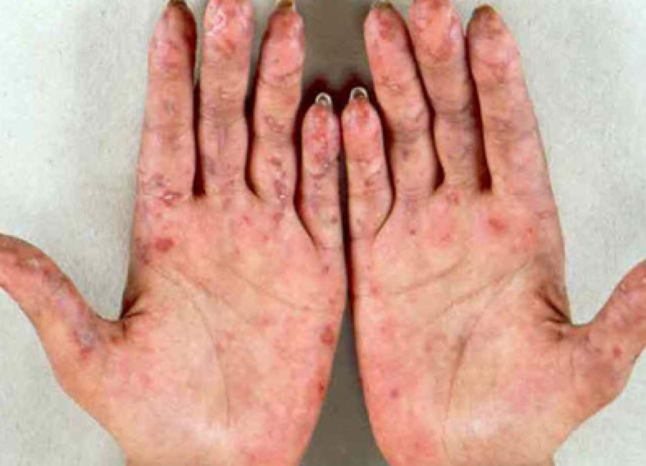 Lo Que Debes Saber Del Lupus El Siglo De Torreón